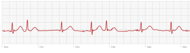 How accurate is the ECG on Apple Watch? – iotnewsdaily.com